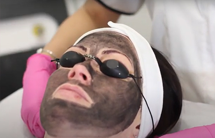 Enhance Your Skincare Routine with Carbon Facials